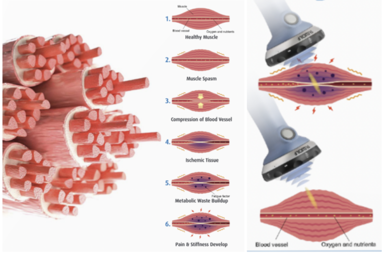 END YOUR PAIN IMMEDIATELY With PiezoWave SHOCKWAVE ! – ACOUSTIC ...